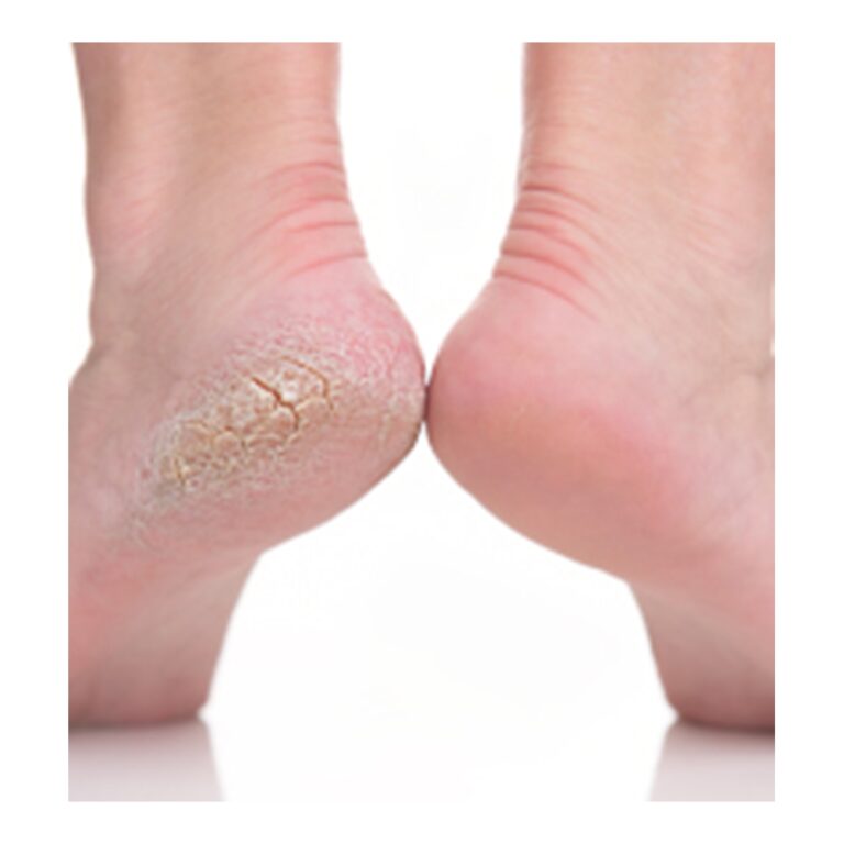 Smelly feet - 1 of 5 common foot problems helped by pedicure